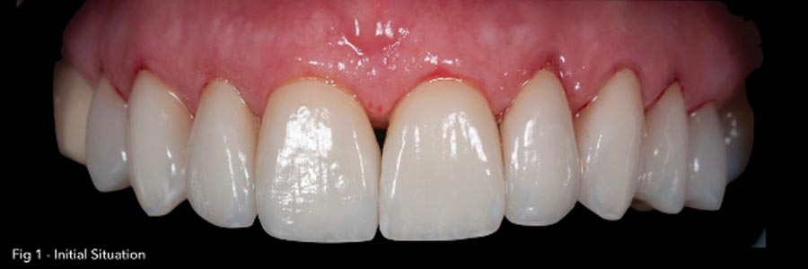 Veneers removal with laser Er,Cr:YSGG 2780 nm - סביון מדיקל סנטר