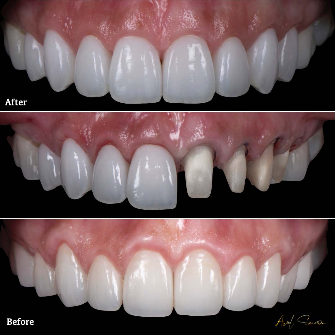 Porcelain Veneers | 10 Essential Tips Before You Start | D.r savyon