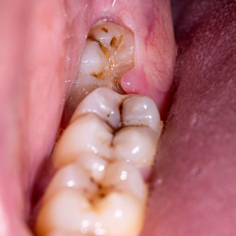 Laser lower wisdom tooth extraction | Painless | Dr savyon