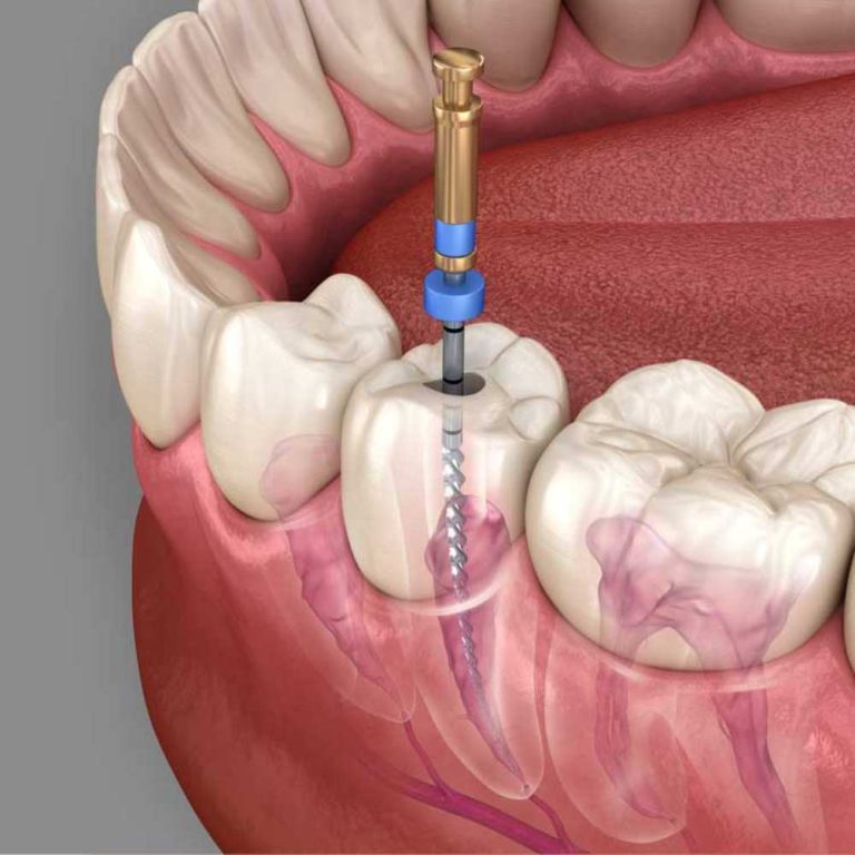 Precision Root Canal | Laser & Microscope | DR. Savion